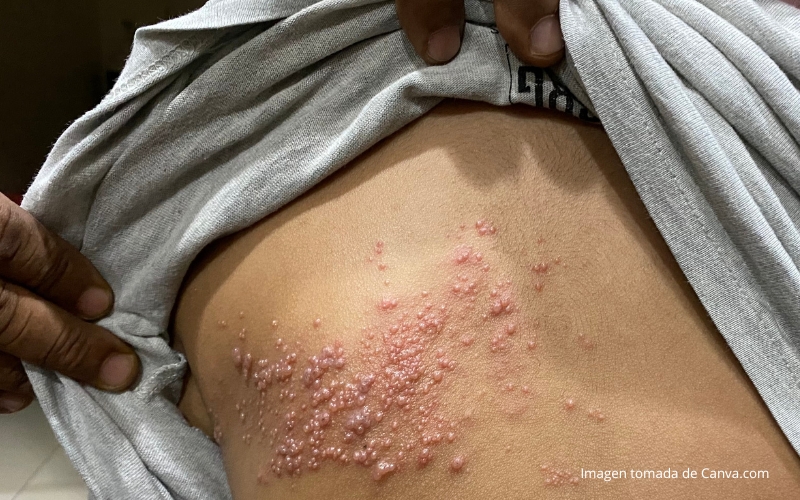 Tratamiento para la Culebrilla en Medellín – Alivio del Dolor | Centro ...