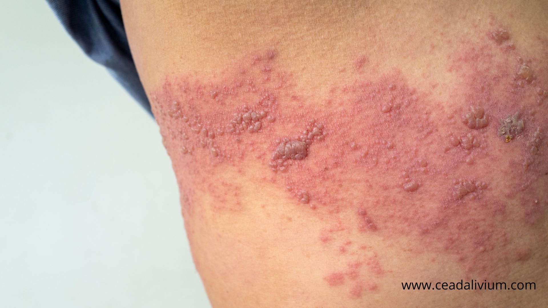 ¿Sufres de culebrilla? En Medellín encuentras el tratamiento ...